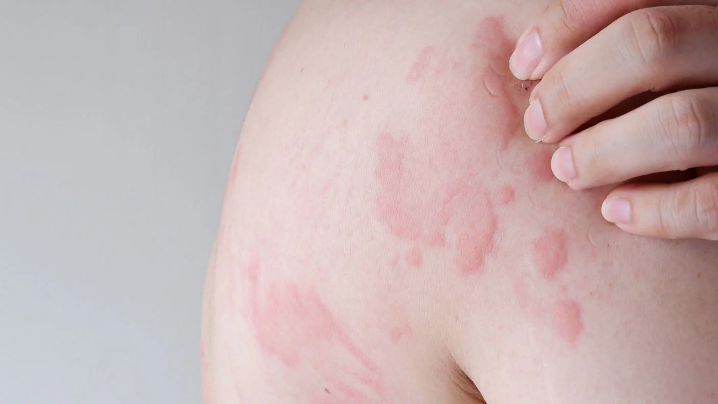 Unusual Treatment for Autoimmune Chronic Hives