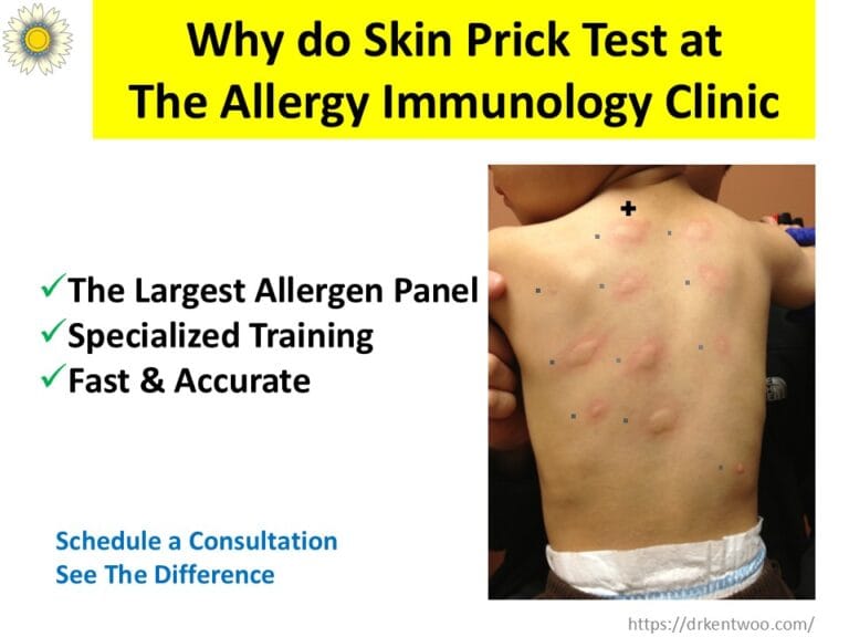 Skin Prick Test for Allergies: What to Expect & Why It’s Painless