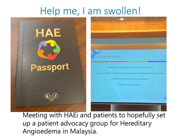 Hereditary Angioedema causes Swelling - Dr Kent Woo