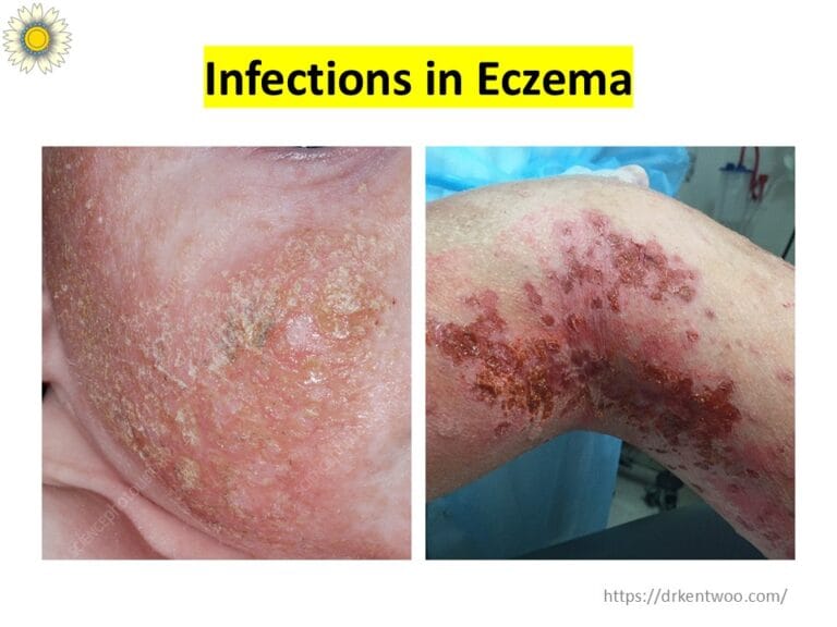 The Heartbreak of Eczema: Understanding Infections in Eczema