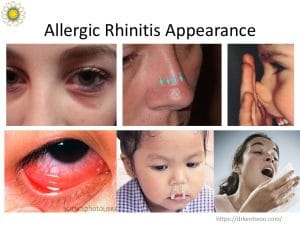 5 Signs of Allergic Rhinitis: How to Spot Allergy Symptoms Early