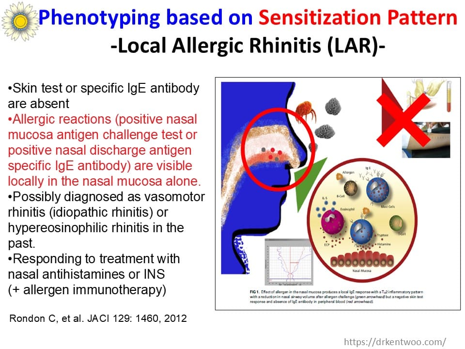 Localized Allergic Rhinitis: When Allergy Tests Are Negative